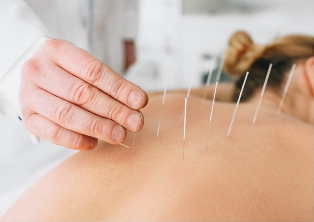 Trigger Point Dry Needling - Prime Sports Therapy | Jupiter, Florida